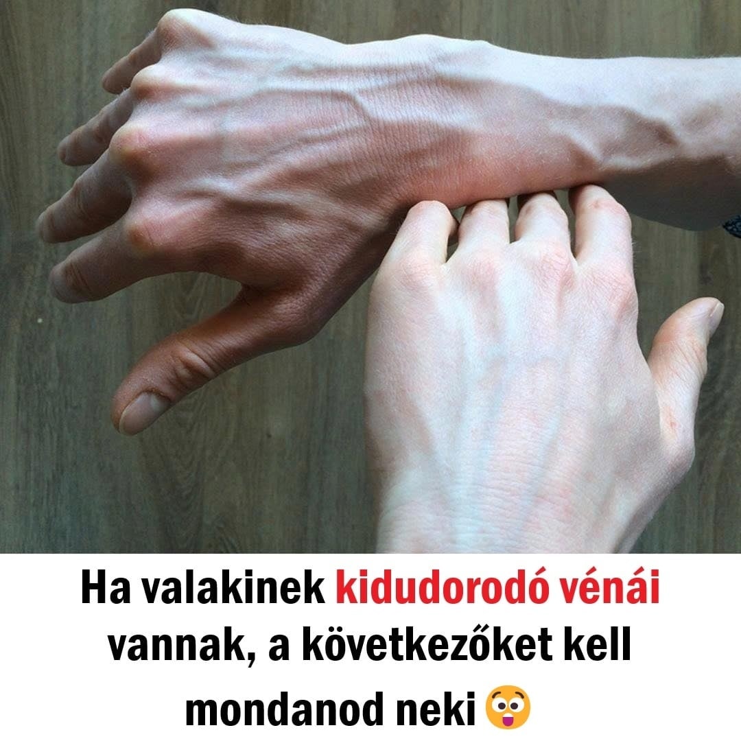 Ha valakinek kidudorodó vénái vannak, a következőket kell mondanod neki